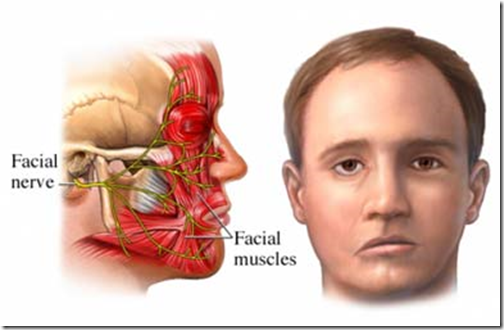 Bells Pares (Perifer facialispares) ~ Medicinanteckningar
